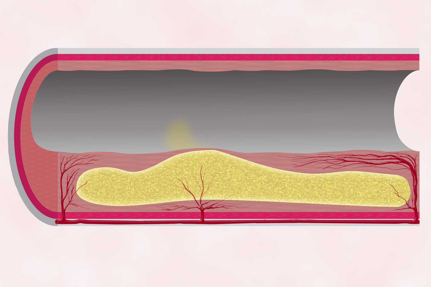 UNE research shows failed plaque healing, rather than plaque rupture ...